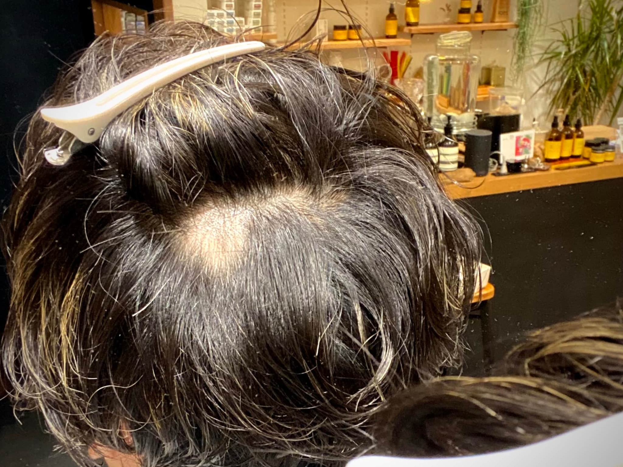 【円形脱毛症】7年ぶりのガイドライン刷新！原因と早く治す方法、最新治療薬を徹底解説します | Pelodias | 奥沢 自由が丘 緑が丘 の間にある完全個室のマンツーマン美容室